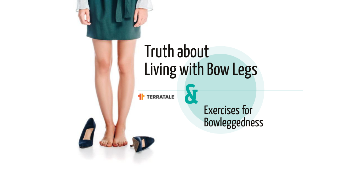 Truth About Living With Bow Legs (Genu Varum) + 7 Exercises